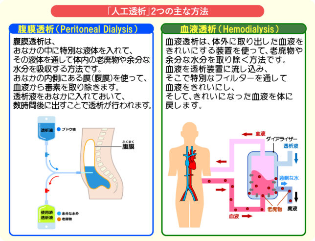 人工透析（透析治療）とは いい老後の解説